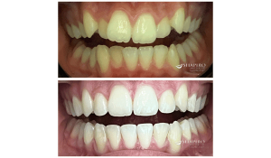 How to Straighten Teeth Without Braces: 6 Reasons to Consider Invisalign | Shapiro Family Dentistry